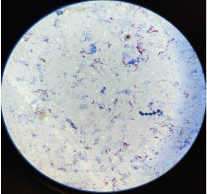 A Comparative Study of Ziehl-Neelsen Stain and Fluorescent Stain ...