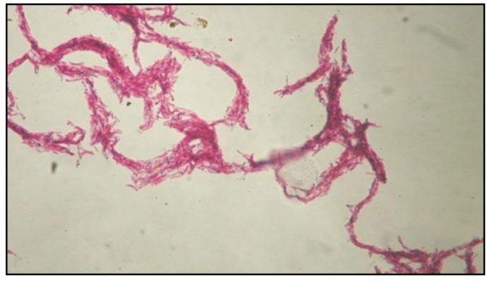 Drug-resistant Tuberculosis: First Line Drug Resistance Pattern among ...
