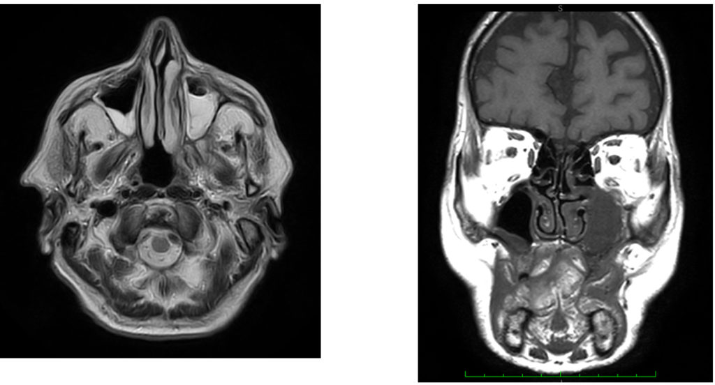 Microbiological and Radiological Perspective of Fungal Rhinosinusitis ...