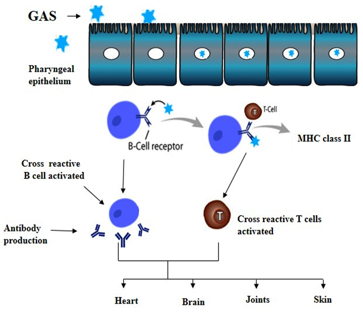 Streptococcal Pharyngitis And Rheumatic Fever Journal Of Pure And Streptococcal Pharyngitis And Rheumatic Fever Journal Of Pure And