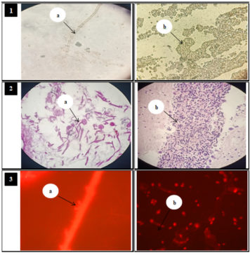 Comparison of Fungal Fluorescent Staining and ITS rDNA PCR-based ...