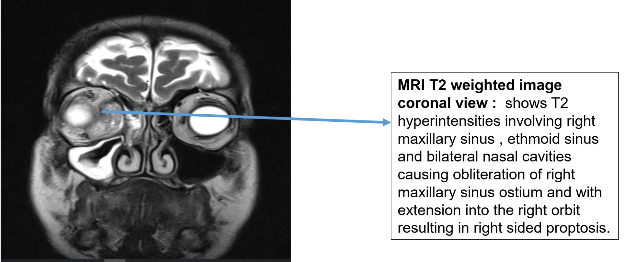 Post-COVID-19 Invasive Fungal Sinusitis: A Case Series from Southern ...