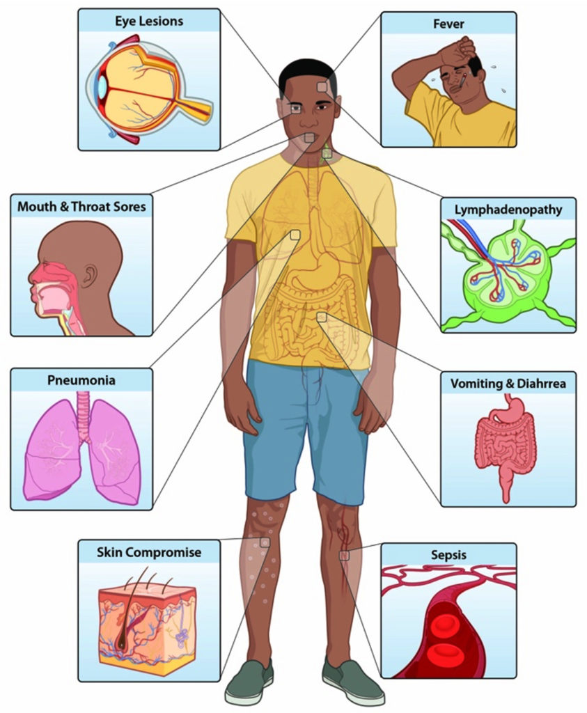 A Review Article on Monkeypox, Infection Transmission, Prevention ...