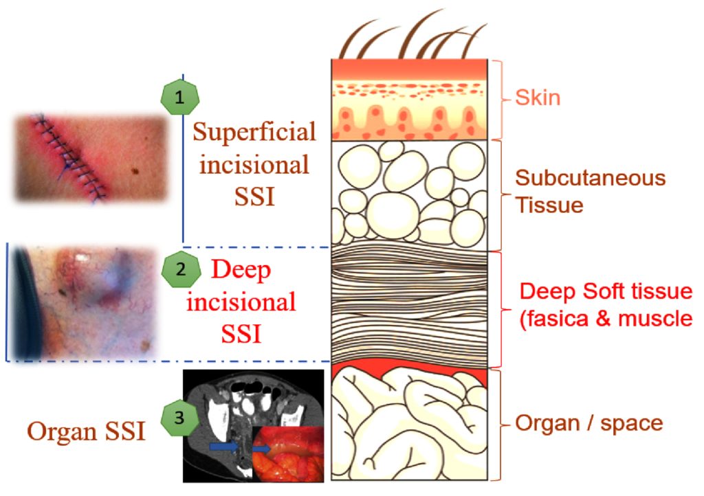 The Emerging Paradigm of Antimicrobial Resistance in Surgical Site ...