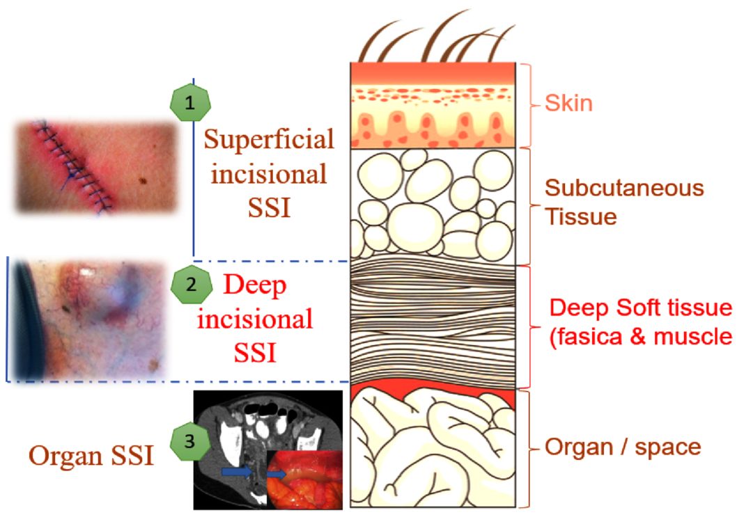 The Emerging Paradigm of Antimicrobial Resistance in Surgical Site ...