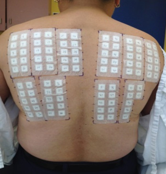 Allergic Contact Dermatitis Due to Chemical Agents and Microbial ...