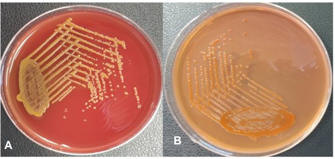 Chryseobacterium Bloodstream Infection in a Case of Non-Hodgkins ...