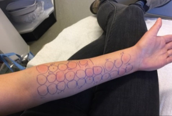 Allergic Contact Dermatitis Due to Chemical Agents and Microbial ...