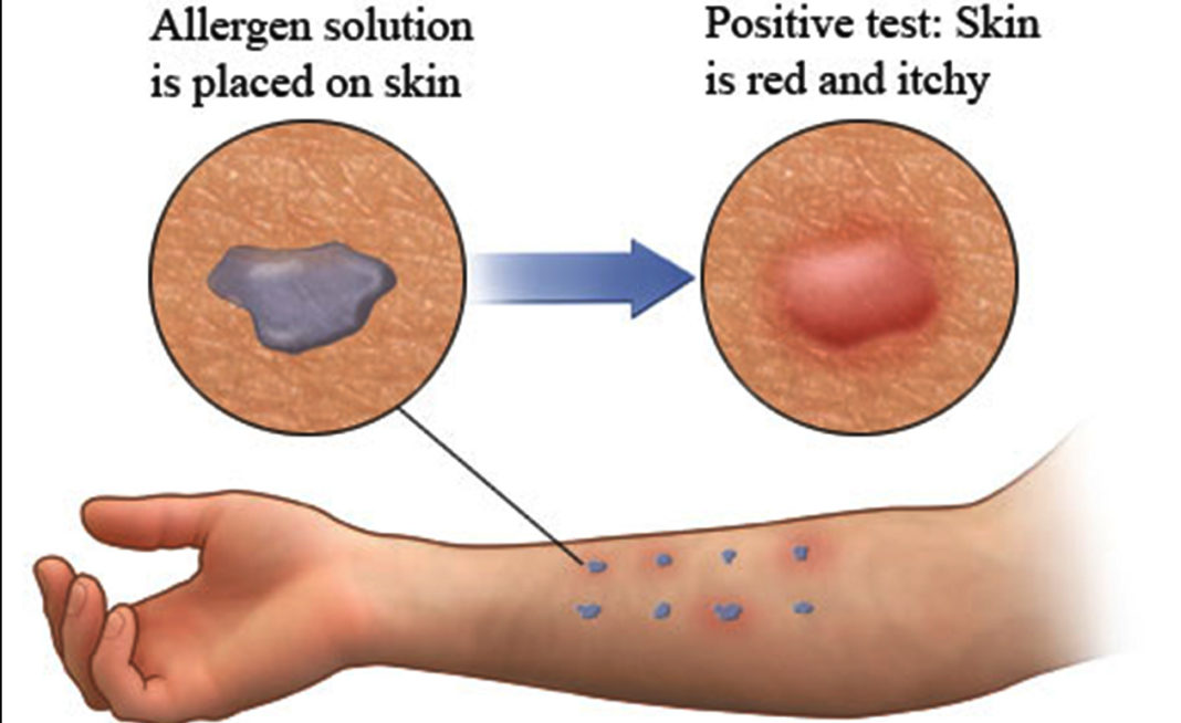 Allergic Contact Dermatitis Due to Chemical Agents and Microbial ...