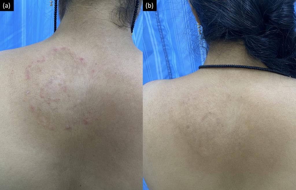 Comparison of Efficacy and Safety between Super-bioavailable ...