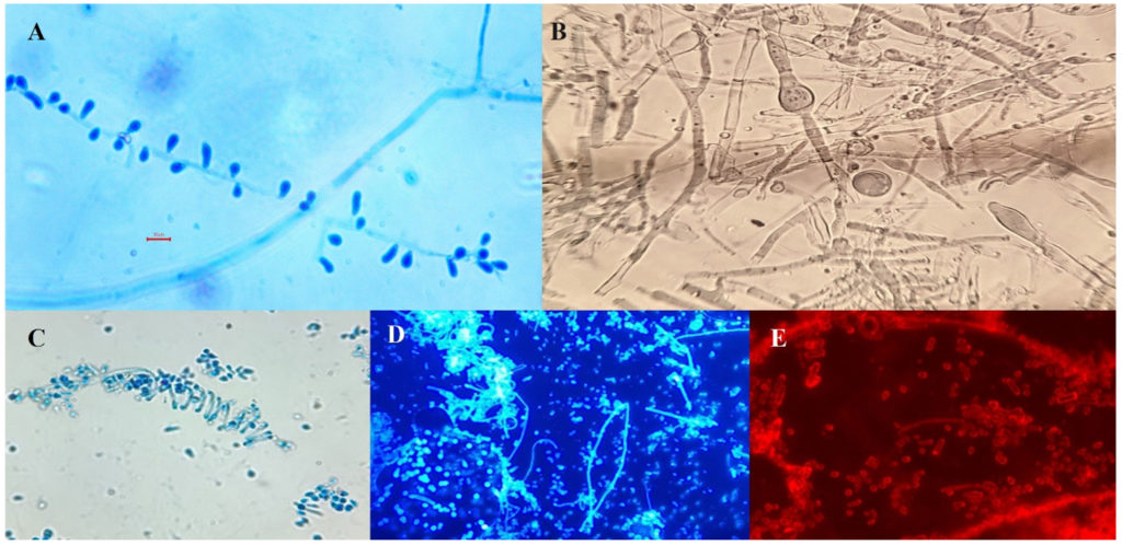 Clinical and Mycological Characterization of Chronic and Recurrent ...