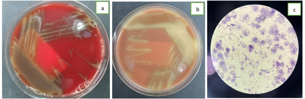Streptococcus mitis and Klebsiella pneumoniae Mixed Infection in Severe ...