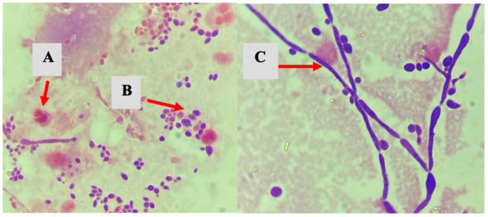 Risk Factors of Candida Urinary Tract Infection in Hospitalised ...